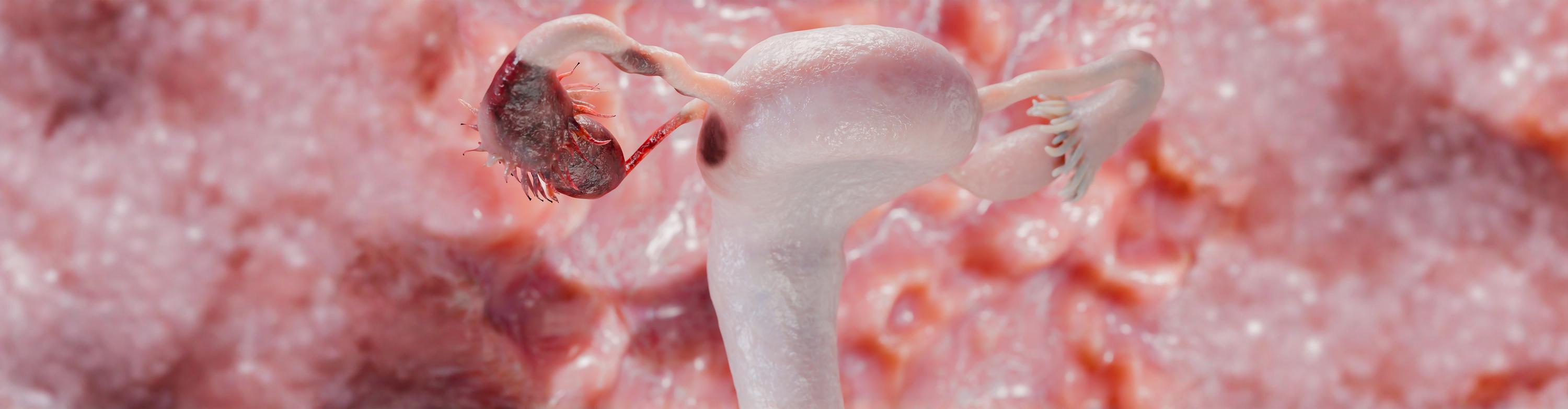 Ovarian Cancer at an Inflection Point: Quantifying the Burden, Closing ...